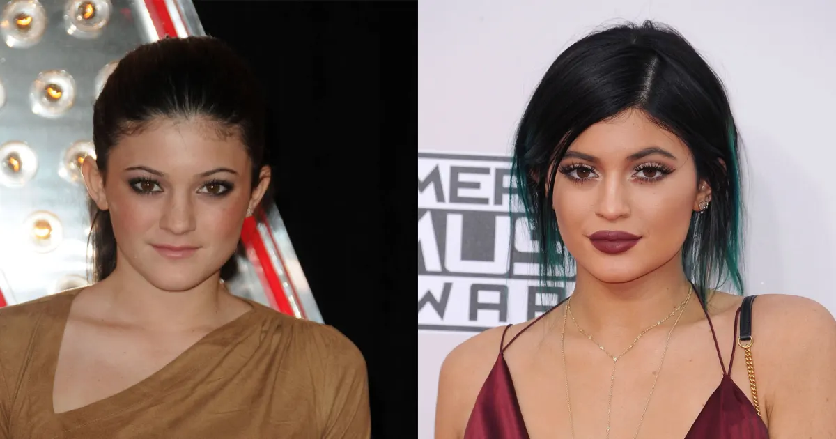 These Stars Have Cosmetically Plumped Their Lips